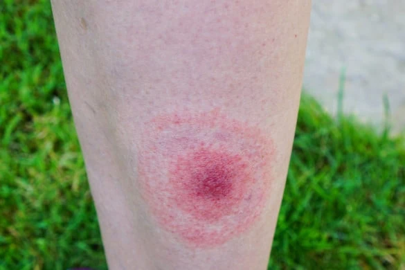 Rocky Mountain Spotted Fever vs. Lyme Disease | IGeneX | Tick Talk